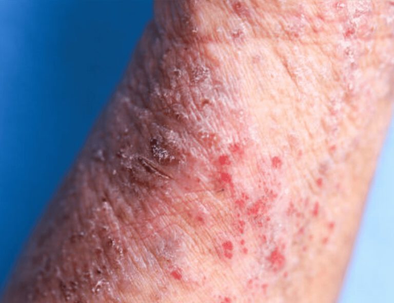 Saúde e Bem Estar – Tratamento da dermatite atópica grave tem avanços ...